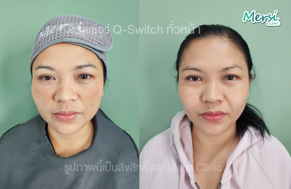 Q-SWITCH LASER ทางออกของปัญหา ฝ้า กระ จุดด่างดำ - Mersi Clinic เมอร์ซี่ ...